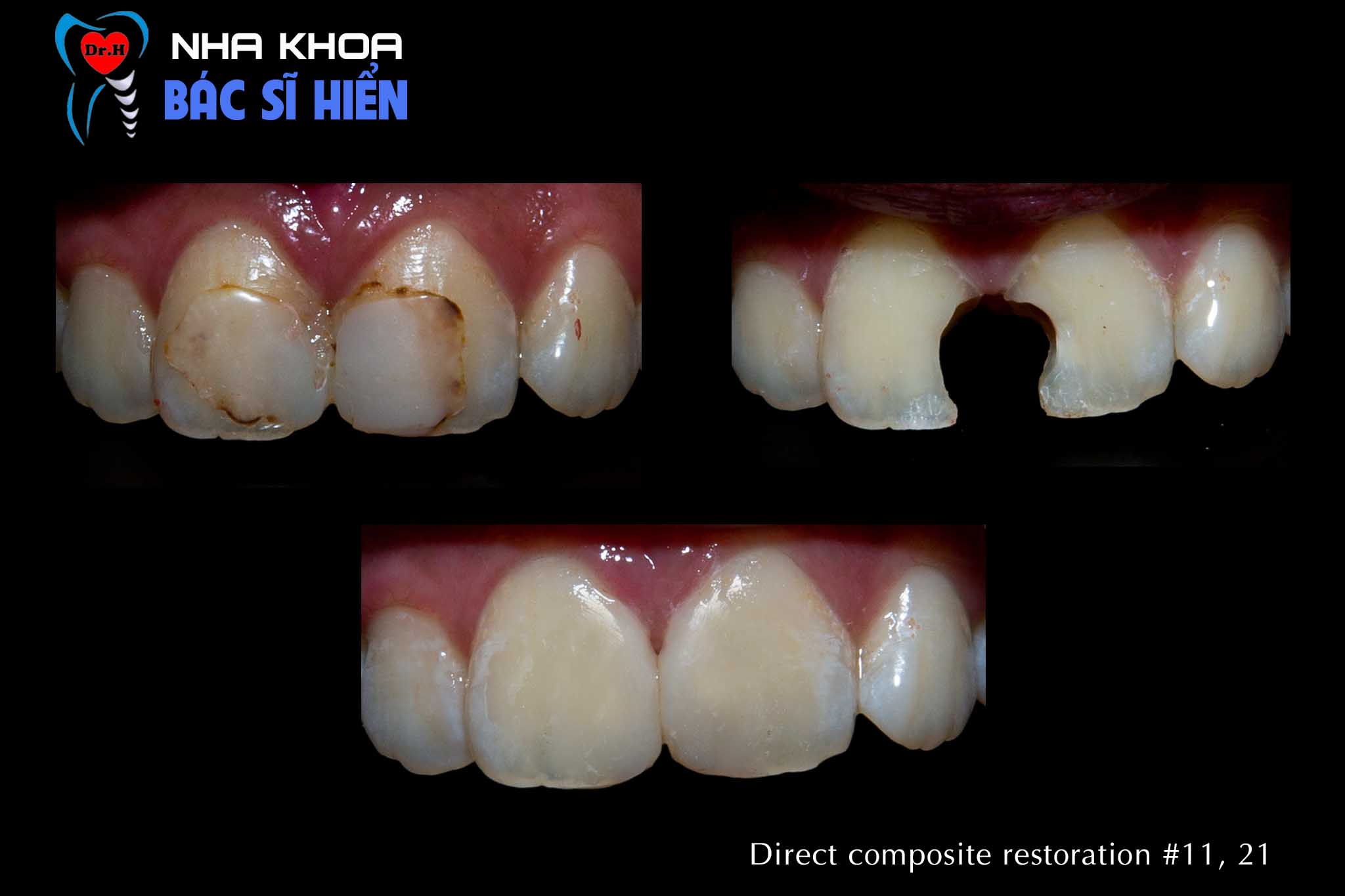 PHỤC HỒI THÂN RĂNG TRỰC TIẾP - Nha Khoa Bác Sĩ Hiển